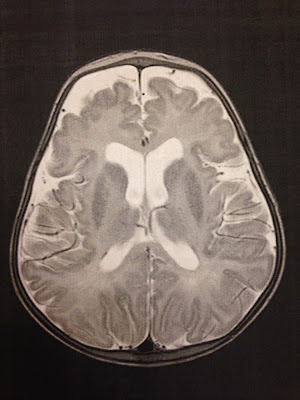 Cicily's Adventures: The incredible shrinking brain